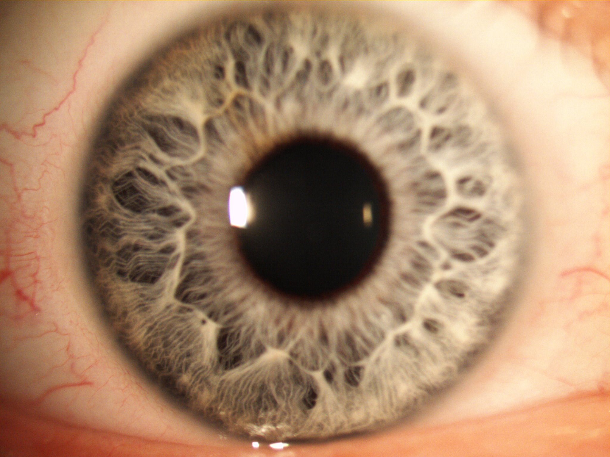 Chirurgie de la cataracte - Centre d'Ophtalmologie Galand